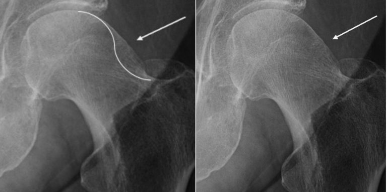 Femoroacetabuläres Impingement » Dr. Robert Url